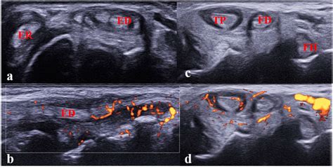 A B Tenosynovitis Of The Extensor Digitorum And Extensor Carpi Download Scientific Diagram