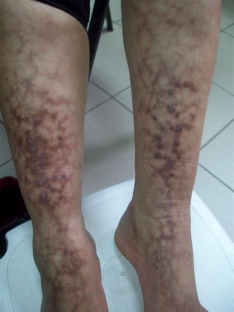 Red Spots On Shins