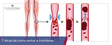 7 Dicas De Como Evitar Trombose I Dra Nayara Coffi Batagini