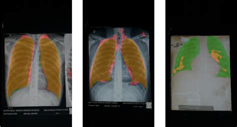 Figure 1 From Development Of A Lung Segmentation Algorithm For Analog