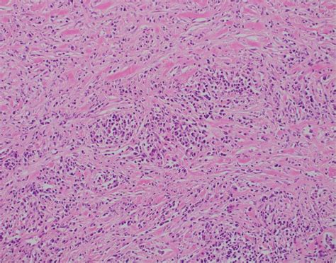 Igg4 Related Disease Mimicking A Paratesticular Tumor And Pelvic Lymph