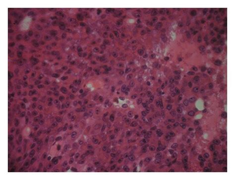 Esophageal Tumor—sheets Of Large Cells With Plasmacytoid Features