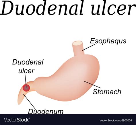Duodenum Ulcer Affected Duodenal Ulcer Royalty Free Vector