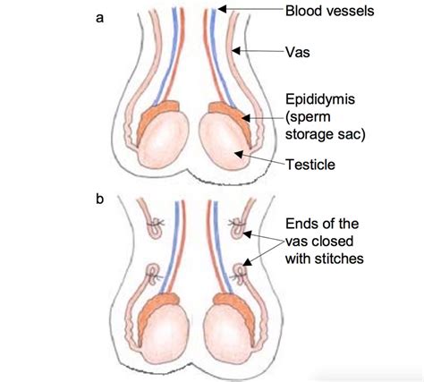 What Is A Vasectomy Natstringersmusings