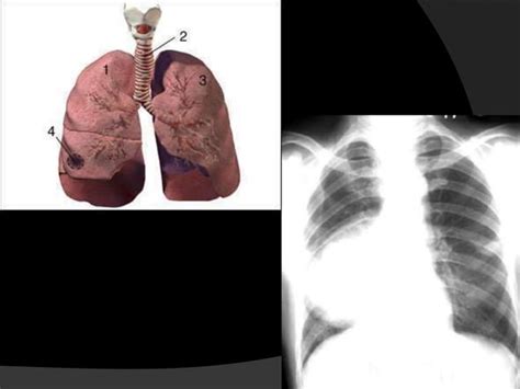 Lung Abscess Ppt