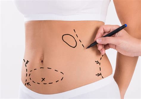 Liposuction Surgery Silkor Kuwait