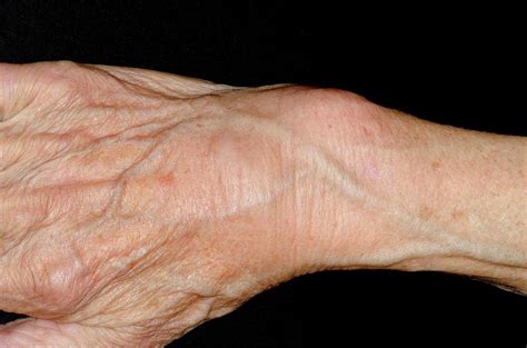 Swollen Sprained Wrist Photograph By Dr P Marazziscience Photo Library
