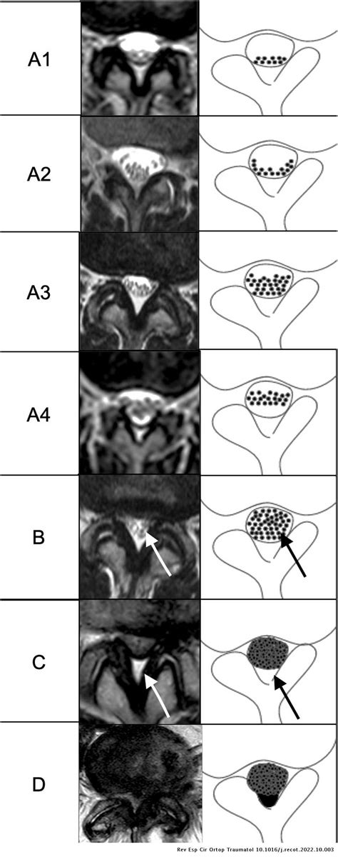 Independent Inter And Intra Observer Agreement Of The Schizass Classification Of Degenerative