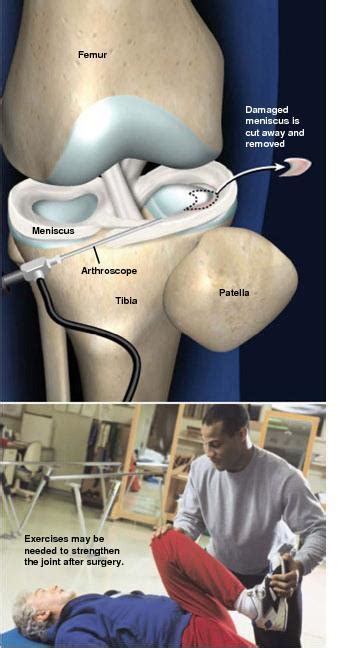 Partial Meniscectomy Sarasota Fl Schofield Hand And Bright Orthopaedics
