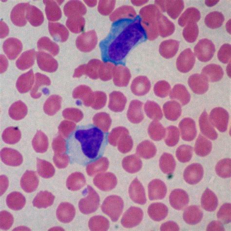 Qué es la meningitis y cuáles son sus síntomas