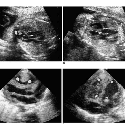 Prenatal Ultrasonographic And Postnatal Mr Findings Of Fetal