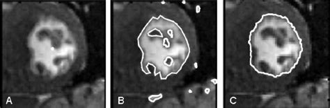 Example Of The Automated Endocardial Surface Detection In One Slice Download Scientific