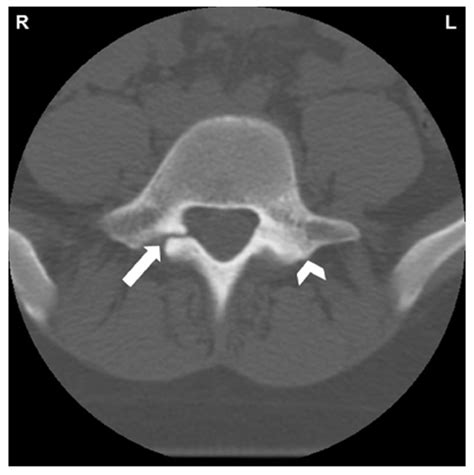 Jcm Free Full Text Pars Interarticularis Fractures Treated With