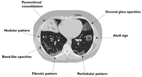 Lung Thorax Chest Hrctthorax Medical Radiologia