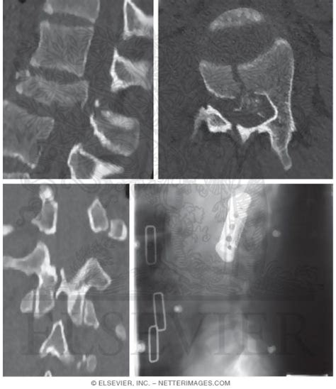 Burst Fracture Lumbar Spine