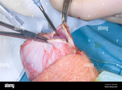 Scrotum Surgery Image 3 Of 9 Surgeon Using An Electrocautery