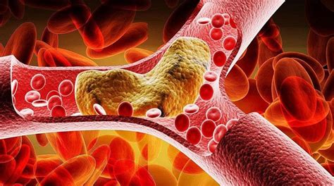 Causes Of Familial Lipoprotein Lipase Deficiency Medichimp