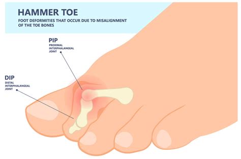 Hammertoe Demystified Symptoms Causes And Treatments Gatsbyshoes