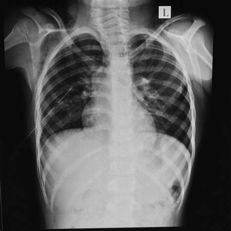 Colonoscopic View Showing A Patchy Nodular Mucosa On Right Side Of Download Scientific