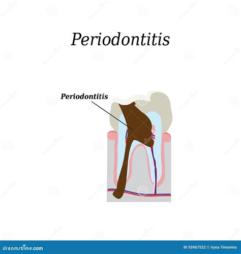 Periodontitis Tooth Vector Illustration On Stock Vector Illustration