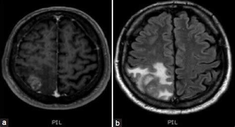 Brain Magnetic Resonance Imaging Mri A Contrast Enhanced