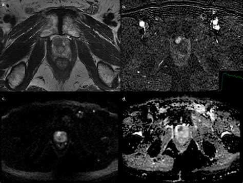 Figure 1 From The Value Of Transperineal Prostate Biopsies With Mmri