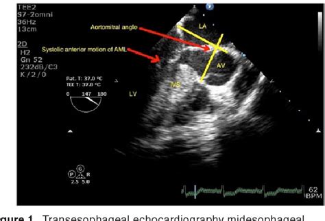Figure 1 From Awareness Of ‘systolic Anterior Motion In Different