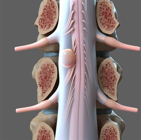 Spinal Cord Tumor Kaggle