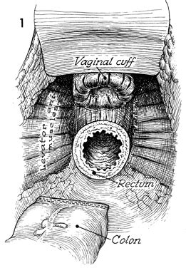 Low Anastomosis Of Colon To Rectum Using The End To End Surgical Stapler Technique