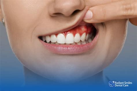 Tooth Abscess Your Complete Guide To Symptoms Treatment And Fast Relief