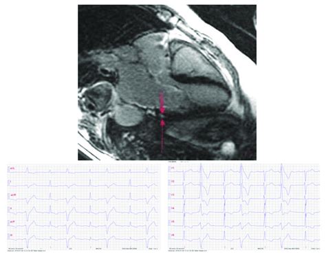 Cmr Image Showing Fibrosis In The Basal Inferolateral Area Of The Left Download Scientific