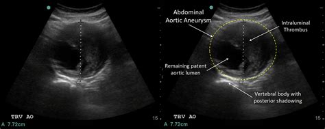 Hennepin Ultrasound Thoracic Aortic Dissection With H