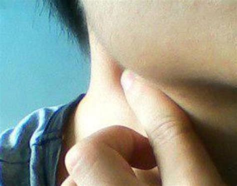 食管癌图片有来医生