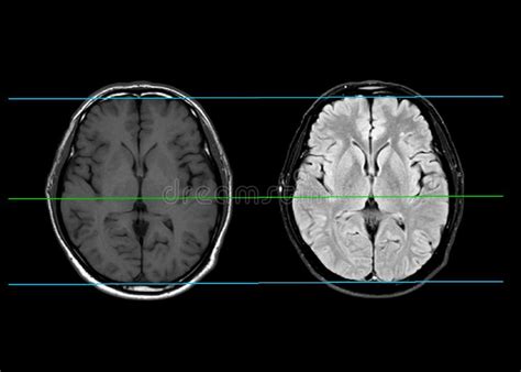 Mri Brain Sagittal And Axial T2 Flair Technique Stock Illustration