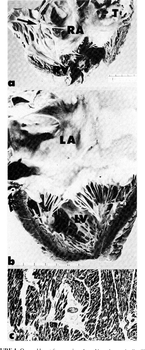 Figure 1 From Idiopathic Restrictive Cardiomyopathy Semantic Scholar