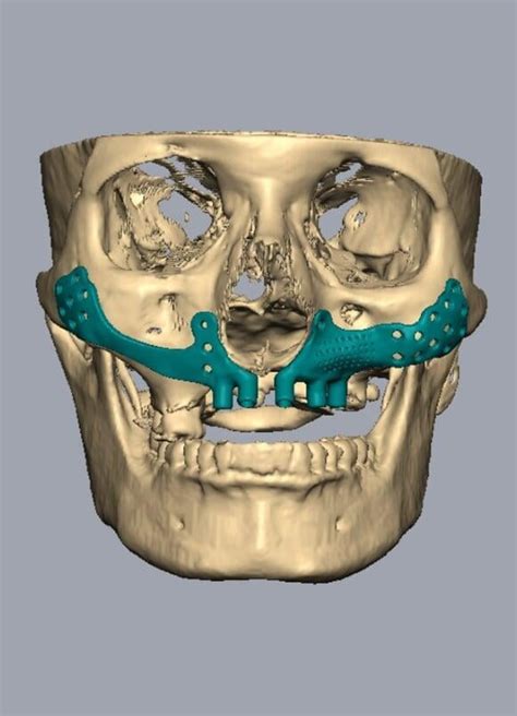 Maxillofacial Lucid Implants Psis For Cmf And Ortho