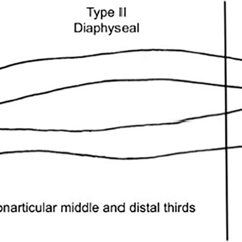 Illustration Of The Vince And Miller Classification With Type I Which