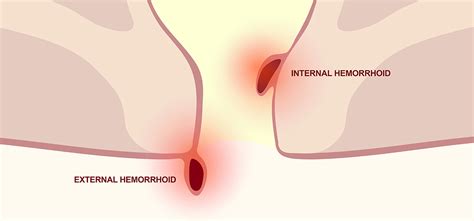 External Hemorrhoids Treatment Heritage Surgical Group