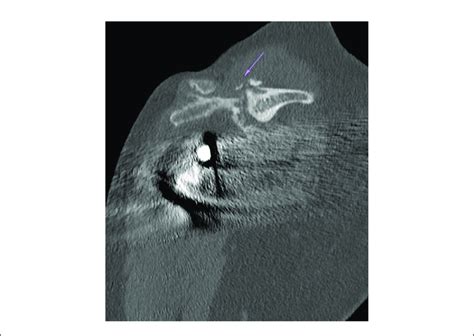 Scapular Spine Fracture Purple Arrow In Lateralized Rsa Global