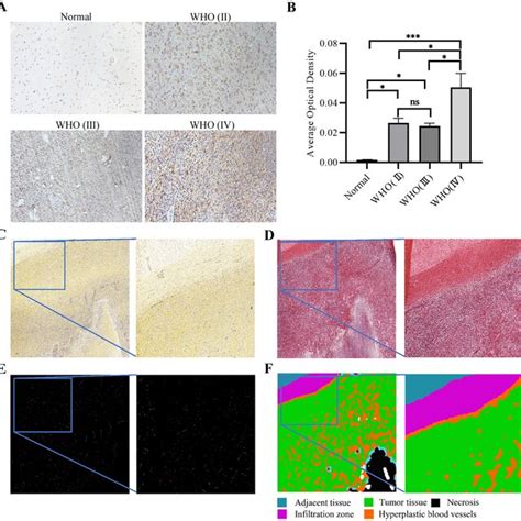 High Expression Of Draxin Based On Glioma Tissues From Laboratory And