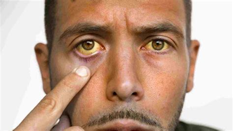 High Bilirubin Levels Symptoms Causes And Effective Treatments