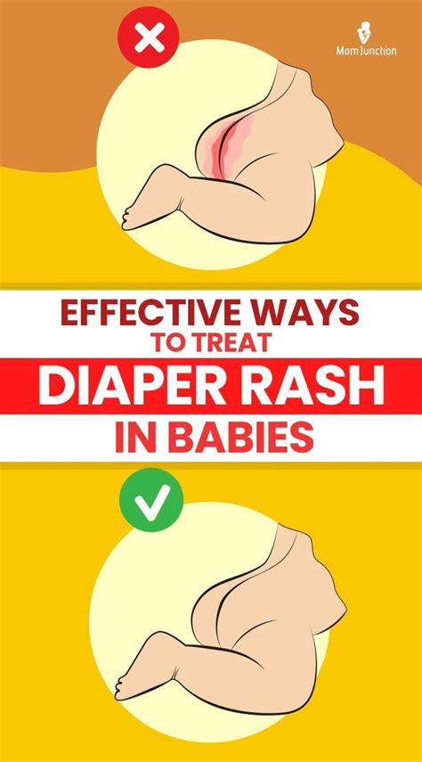 Yeast Infection Diaper Rash Artofit