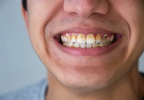 Which Tooth Has 4 Cusps A Quick Guide To Identifying Your Teeth