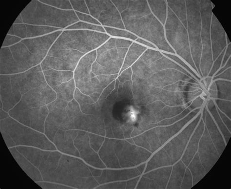 Idiopathic Choroidal Neovascularization Retina Image Bank