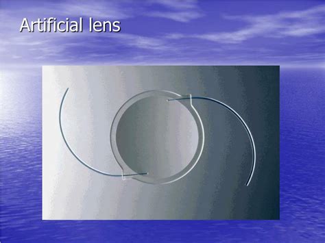 Ppt Lecture 3 Cataracts Powerpoint Presentation Free Download Id
