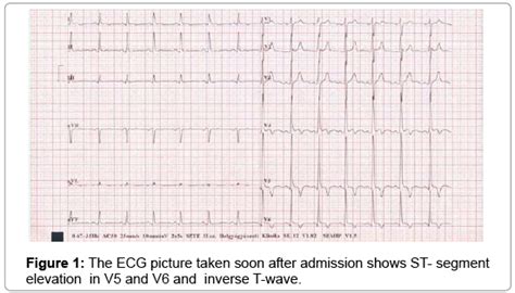 Myocarditis Ekg Viral Myocarditis And Dilated Cardiomyopathy