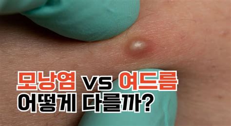 여드름 모낭염 차이 3가지 원인 구분법 치료 방법 네이버 블로그