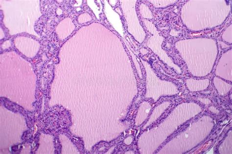 Endemic Goiter Light Micrograph Stock Image Image Of Thyroid Goiter