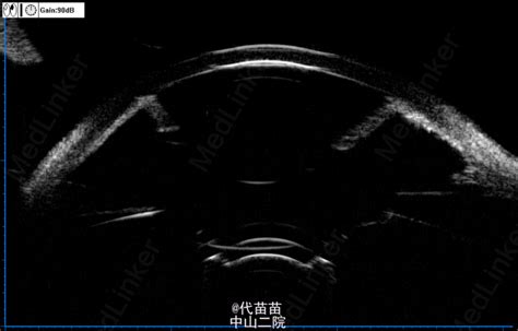 继发性青光眼 医联