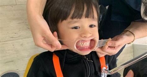 N샷 윌리엄 치과 치료 인증개구기 끼고 의젓하게 깜찍